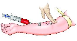 Platelet Rich Plasma for Chronic Pain Conditions