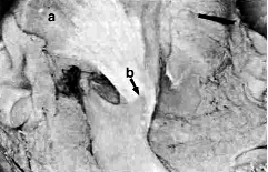 Orbital-Inner Canthus Headache due to Medial Temporal Tendonitis