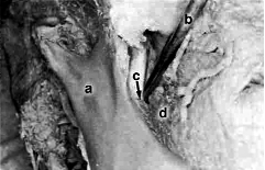 Orbital-Inner Canthus Headache due to Medial Temporal Tendonitis