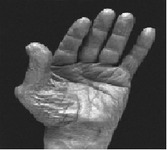 Non-surgical Decompression Treatment for Carpal Tunnel Syndrome