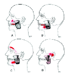 Trigger Point Ablation and TMJ Syndrome