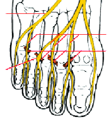 Neuroma Pain of the Foot Successfully Managed with Laser Therapy