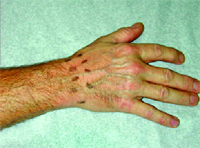 Dextrose Prolotherapy for Unresolved Wrist Pain