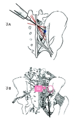 Platelet-Rich Plasma Prolotherapy for Low Back Pain Caused by ...
