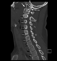 Occipito-Atlanto (C0-C1) Joints as a Source of Spinal Pain