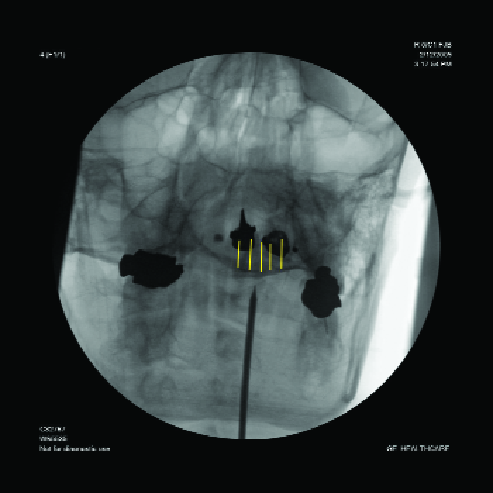 Occipito-Atlanto (C0-C1) Joints as a Source of Spinal Pain