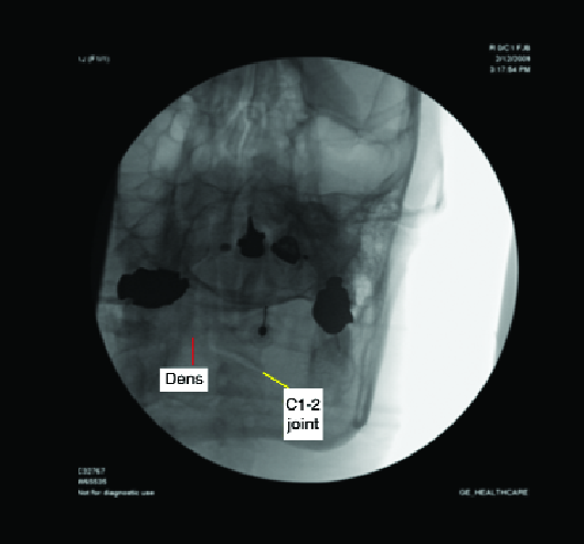 Occipito-Atlanto (C0-C1) Joints as a Source of Spinal Pain