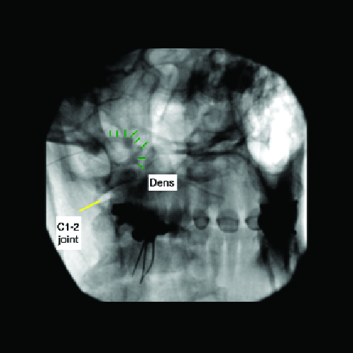 Occipito-Atlanto (C0-C1) Joints as a Source of Spinal Pain