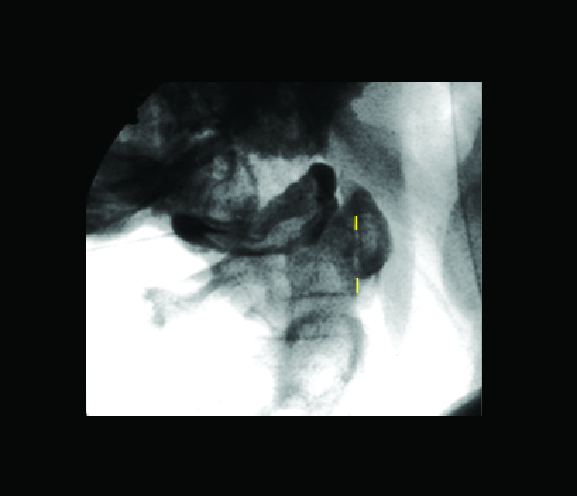 Occipito-Atlanto (C0-C1) Joints as a Source of Spinal Pain
