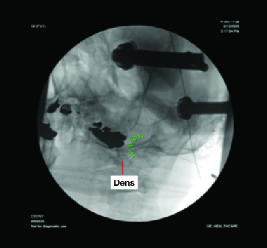 Occipito-Atlanto (C0-C1) Joints as a Source of Spinal Pain