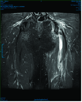 Platelet Rich Plasma for Hamstring Tears