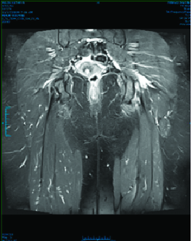 Platelet Rich Plasma for Hamstring Tears
