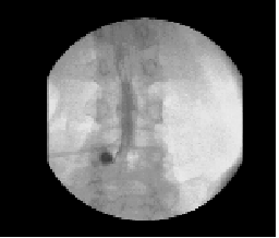 Avoiding Complications From Interventional Spine Techniques