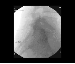 Avoiding Complications From Interventional Spine Techniques