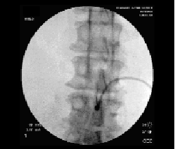 Avoiding Complications From Interventional Spine Techniques