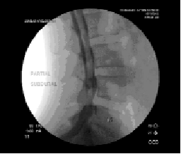 Avoiding Complications From Interventional Spine Techniques