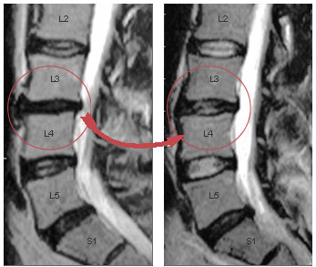 Distraction Techniques for Lumbar Pain