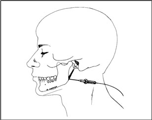 Ernest Syndrome and Insertion of the SML at the Mandible