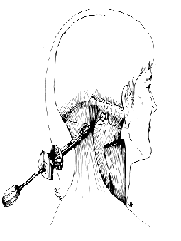 Splenius Capitis Muscle Syndrome