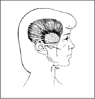 Temporal Tendinitis Migraine Mimic