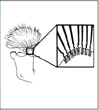 Temporal Tendinitis Migraine Mimic