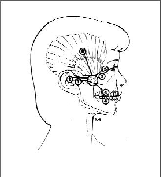 Temporal Tendinitis Migraine Mimic