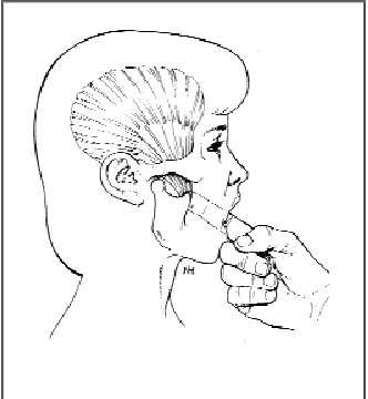 Temporal Tendinitis Migraine Mimic