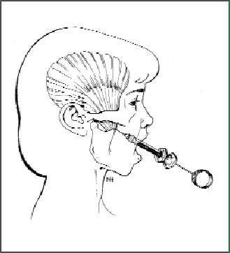 Temporal Tendinitis Migraine Mimic