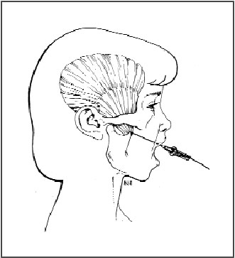 Temporal Tendinitis Migraine Mimic