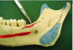 Superior Constrictor Muscle Action