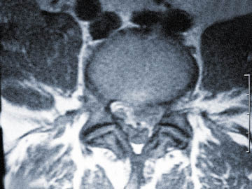 Spontaneous Low Back Pain, Radiculopathy, And Weakness in a 28-Year-Old