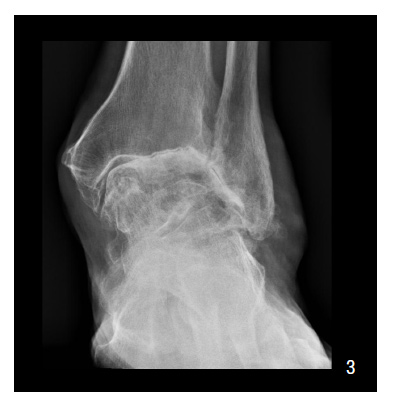 Nonsurgical Treatments for Ankle Arthritis