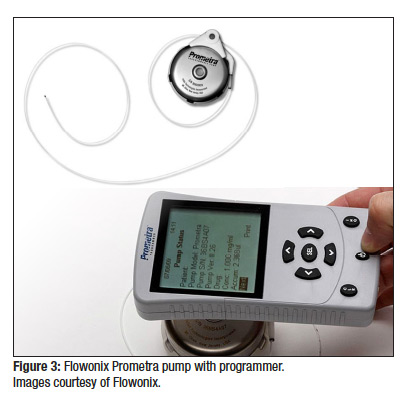Guide to Implantable Devices For Intrathecal Therapy