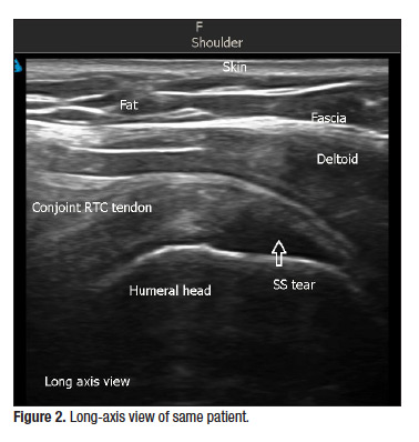 Use of Ultrasound in Detection Of Rotator Cuff Tears