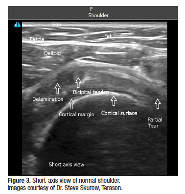 Use of Ultrasound in Detection Of Rotator Cuff Tears