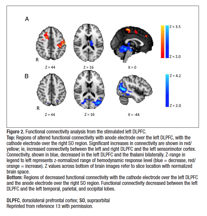 Transcranial Direct Current Stimulation (tDCS): What Pain Practitioners ...