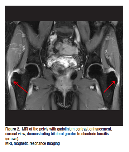 Latest Advances In the Diagnosis And Treatment Of Polymyalgia Rheumatica