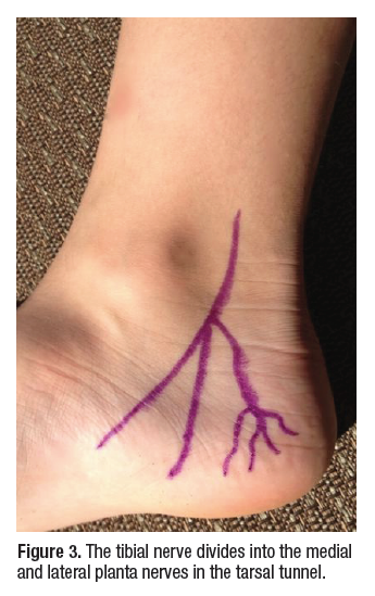 Nerve Decompression Surgery Can Reverse Neuropathy of the Foot