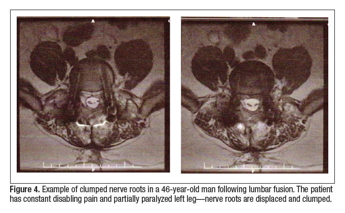 Arachnoiditis: Diagnosis and Treatment