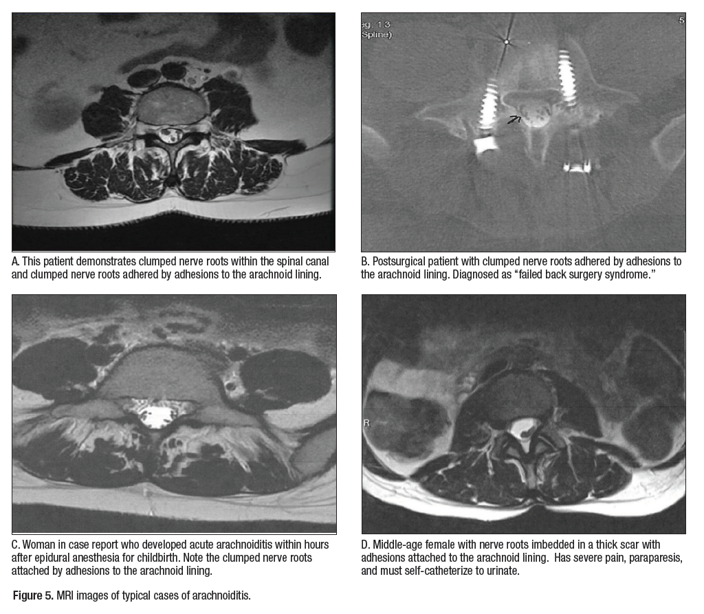 Arachnoiditis: Diagnosis and Treatment