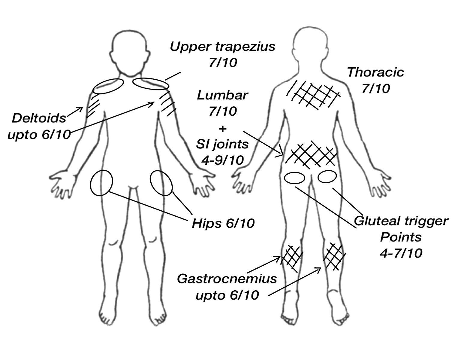 Mapping Complex Pain: A Case Study