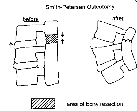 Decisions and Expectations with Osteotomy Surgery for Fixed Sagittal ...