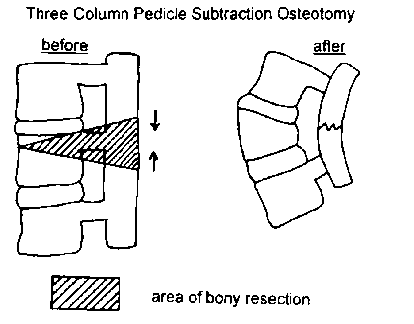 Decisions and Expectations with Osteotomy Surgery for Fixed Sagittal ...