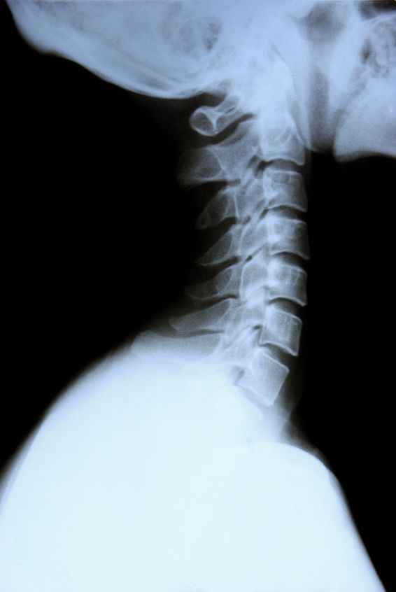 Cervical Spine Injuries, Fractures and Whiplash - Avulsions at C5