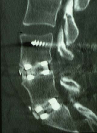 Degenerative Disc Disease at L4-L5 and L5-S1