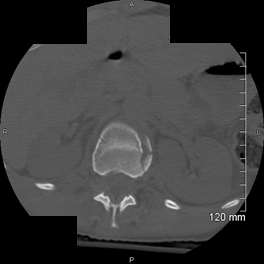 Traumatic L1 Vertebral Body Fracture