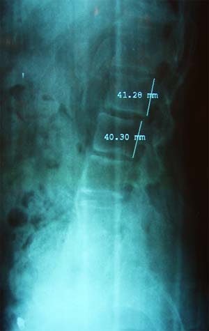 Low Back Pain with L1-L3 Degeneration and L1-L2 Instability