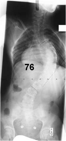 Progressive 90-degree Scoliosis