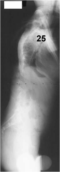 Progressive 90-degree Scoliosis