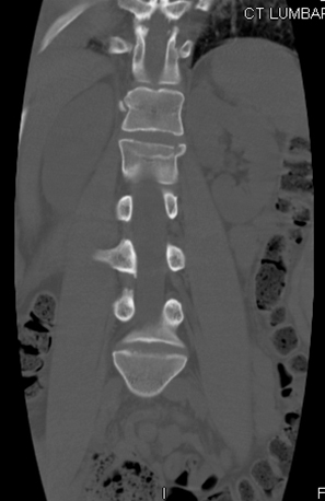 Traumatic L1 Vertebral Body Fracture